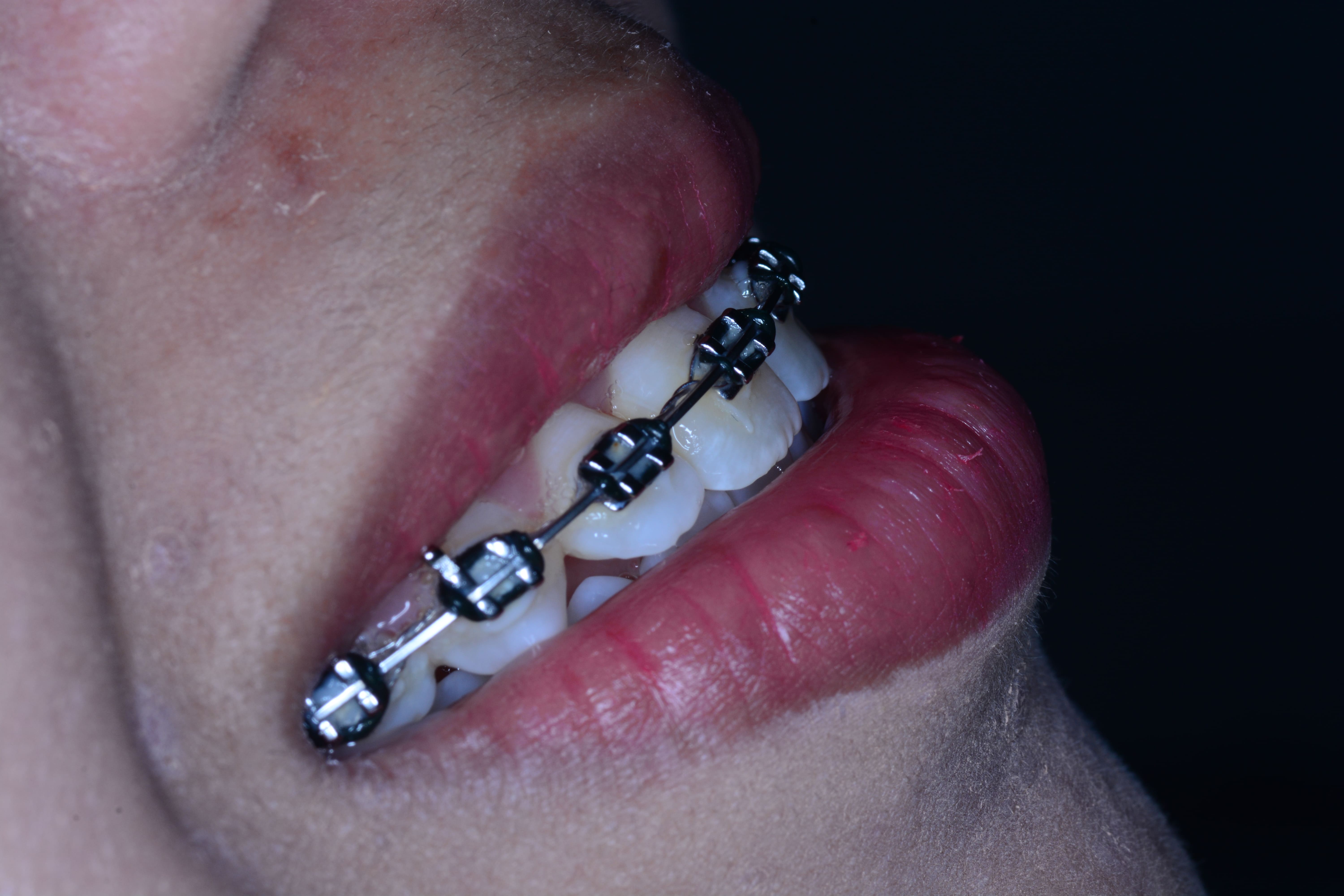 Braces